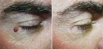 New & Easy Solution for Unwanted Moles