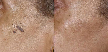 New & Easy Solution for Unwanted Moles